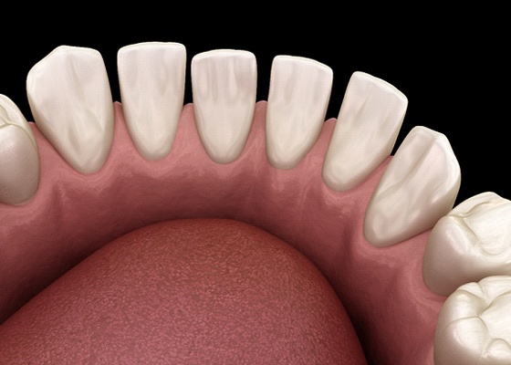 Invisalign For Spaces Between Teeth Annapolis Goodman Dental Care
